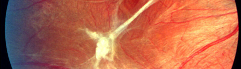 Macular Pucker Atlanta | Retina Eye Care Atlanta | Georgia Retina