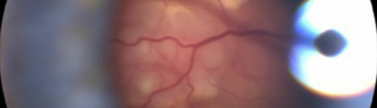 Tumors of the Eye Atlanta | Eye Tumors Treatment Atlanta | Georgia Retina